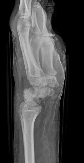 Perilunate Dislocation
