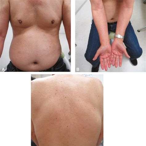 No Recurrence Of Skin Rash After Resuming The Treatment With Download Scientific Diagram