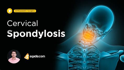 Cervical Spondylosis Orthopedic Surgery Video Medical Online