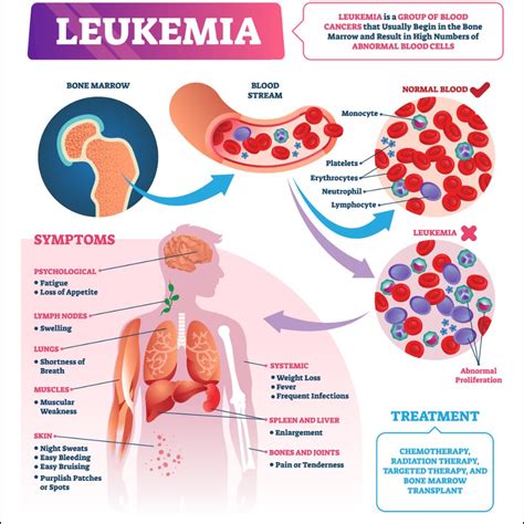 Leukemia Causes Risk Factors Symptoms Treatment