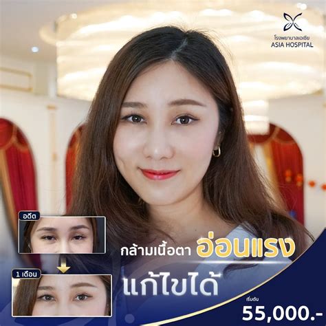 กล้ามเนื้อตาอ่อนแรง เสริมจมูก เอเชียคลีนิก หมอทนงศักดิ์