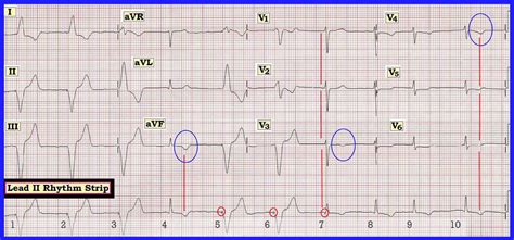 Ecg Interpretation Ecg Interpretation Review 17 Older Woman With A Pacemaker And Chest