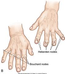 Na645 Wk 2 Ch 37h Alterations In Musculoskeletal Function Flashcards