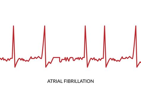 Exercise For Atrial Fibrillation What Are The Safe Exercise To Do