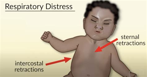Pediatrics Respiratory Flashcards Quizlet