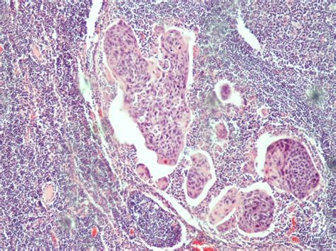 Hande ×100 Lymph Node Metastasis Only From The Squamous Element