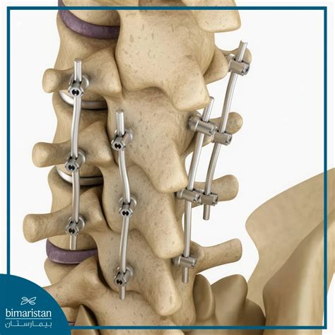Cervical Spine Fusion Surgery In Turkey Methods And Outcomes