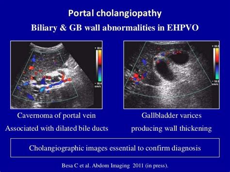 Doppler Ultrasound Of Portal Vein Thrombosis