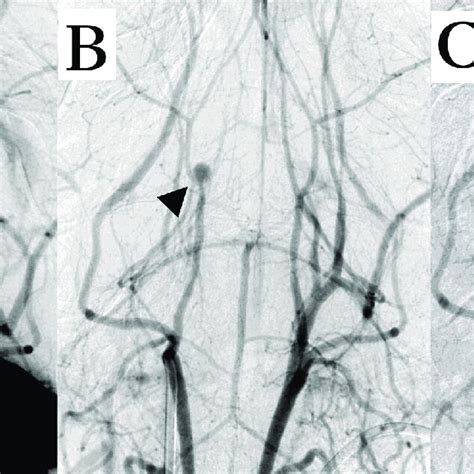 In Vivo Dsa Showed Intracranial Pseudoaneurysms In Three C57bl 6j Mice