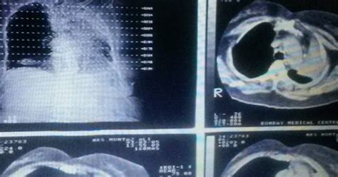 Homeopatia Medicina Basada En La Evidencia Caso Clinico De Cancer De Pulmon Con Homeopatia