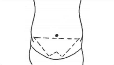 Figure Demonstrating The Excision Of Suprapubic Fat And W Shaped