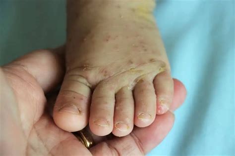 Scabies Rash On Palms Of Hands