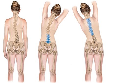 Lumbar Scoliosis Exercises