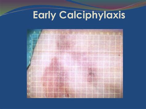 Calciphylaxis Cua Biju Cherian M D Renal Medicine Associates 2 24 18 Ppt Download