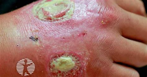 Pyoderma Gangrenosum Image