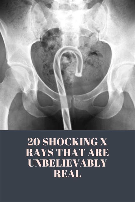 Shocking X Rays That Are Unbelievably Real X Ray Medical Problems Hilarious