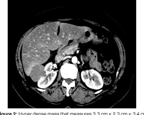 Figure 2 From A Case Report Of A Xanthogranulomatous Pyelonephritis Case Mimicking The