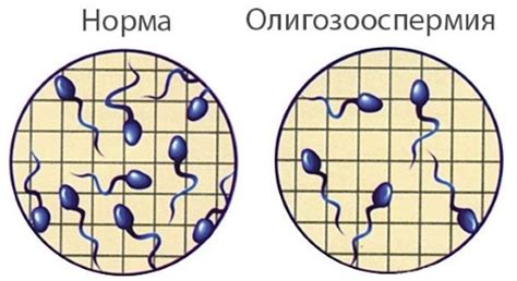 Причины олигозооспермии Как лечить олигозооспермию