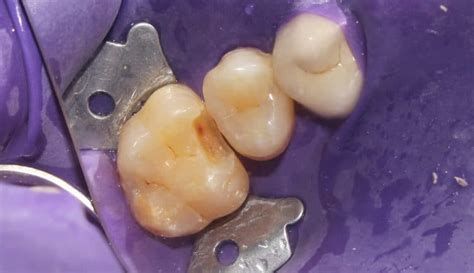 Molar Class 2 Myzerodonto