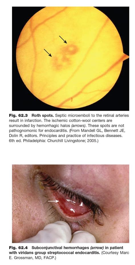 Bacterial Endocarditis Rebel Em Emergency Medicine Blog