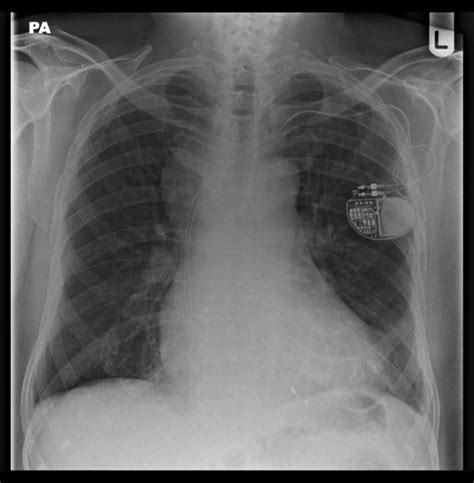 Silicosis Eggshell Calcification