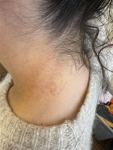 Sudden Rash Rdermatologyquestions