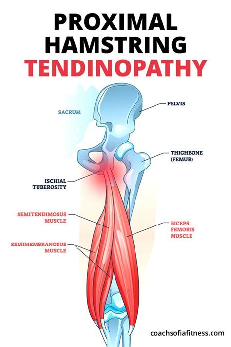 Hamstring Tendonitis Rehab Exercises For Relief Coach Sofia Fitness