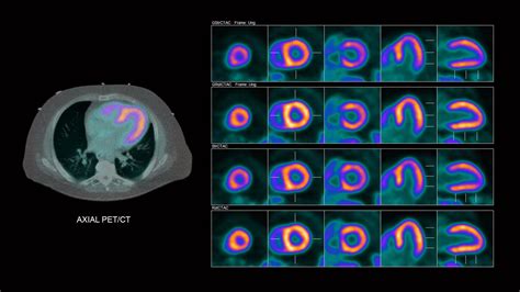 Petnet On Cardiology Siemens Healthineers