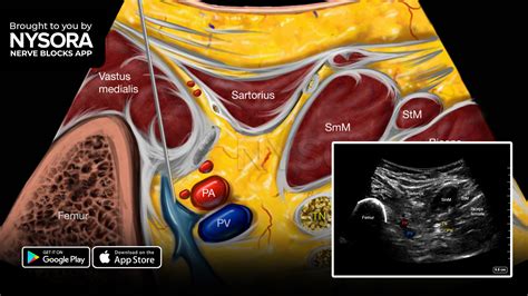 Nysora Distaler Ischiadicusblock Nysora Distaler Ischiadicus Block