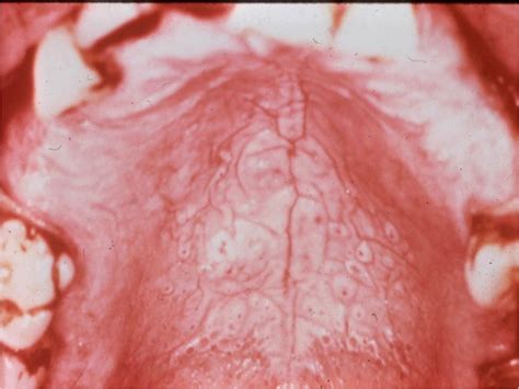 Dentistry Lectures For Mfdsmjdfnbdeore Facts On Leukoplakia