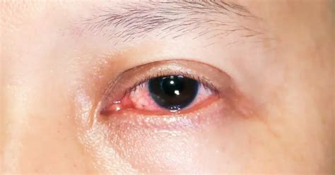 Pink Eye Vs Allergies Dont Risk Misdiagnosing It