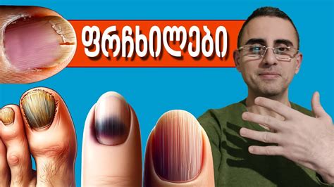 რას გვეუბნება ფრჩხილები ჯანმრთელობაზე მსხვრევადი სწორი ხაზები თეთრი ლაქები Youtube