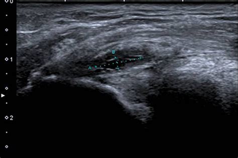 Ultrasound Of Common Extensor Tendon Intrasubstance Tear Confirmation Download Scientific