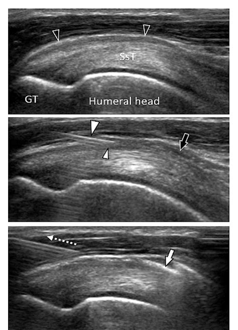Posterior Subacromial Steroid Injection Download