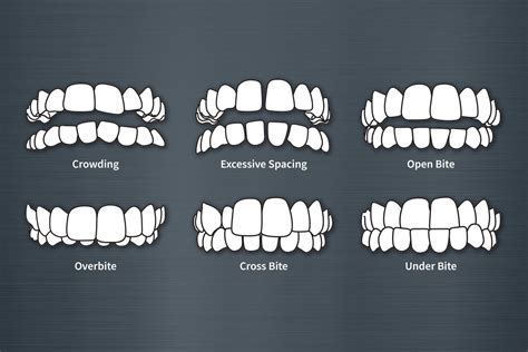Bite Correction With Braces Affordable And Acccurate