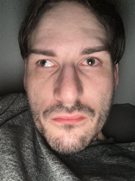 Redness After Scleral Buckle Surgery Reyedoctors