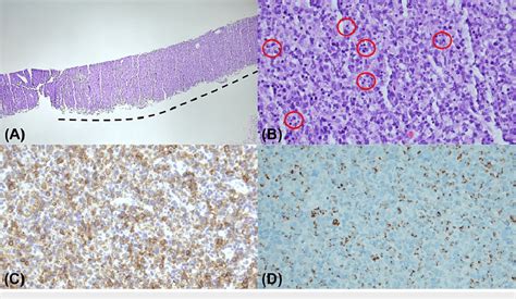 Pathology Findings A The Core Needle Biopsy Specimen From The Right Download Scientific