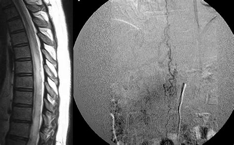 Dr Balaji Anvekar Frcr Foix Alajouanine Syndrome