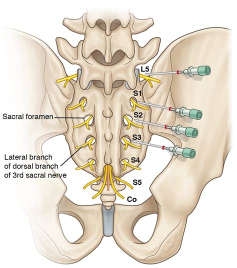 Sacral Lateral Branch Nerve Block Anesthesia Key