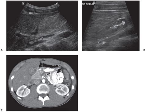 Gallbladder Polyp Histology