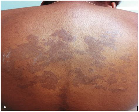 Hiv Skin Rash African Americans