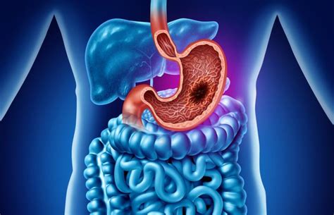 10 Silent Signs Of Stomach Cancer To Read Now Indulging Health