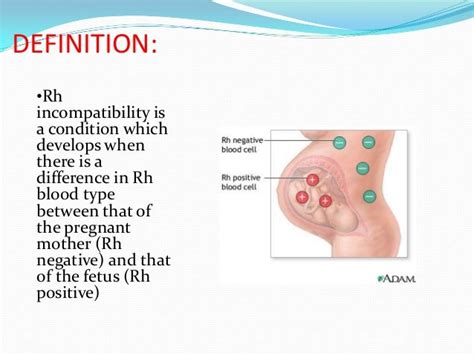 Rh Incompatibility