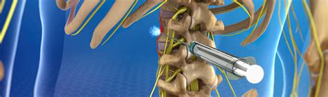 Sympathetic Nerve Block Trimed Spine And Joint