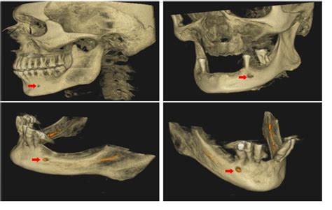 Figure 1 From Cone Beam Ct Description Of Mental Foramen Variants A Review Semantic Scholar