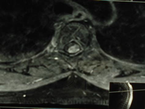 Intradural Extramedullary Metastasis From Papillary Carcinoma Of Thyroid Bmj Case Reports
