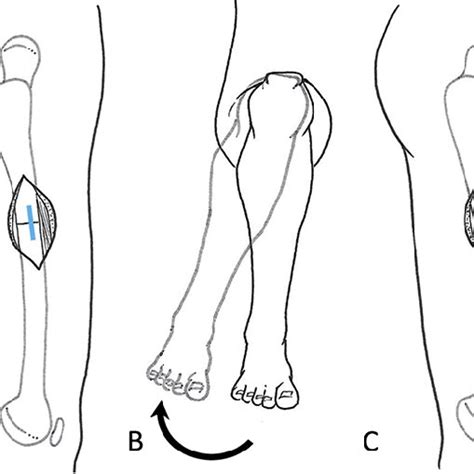 Example Of Correction Performed During A Right Fdo A Alignment Prior Download Scientific