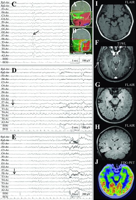 A B Interictal Electroencephalography Eeg Demonstrates Paroxysmal Download Scientific