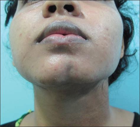 Morphea Face