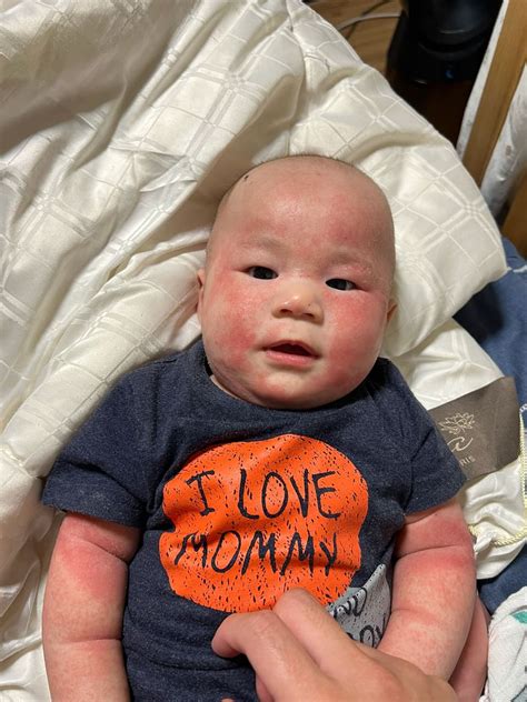 育兒 異位性皮膚炎甘苦談 親子板 Dcard